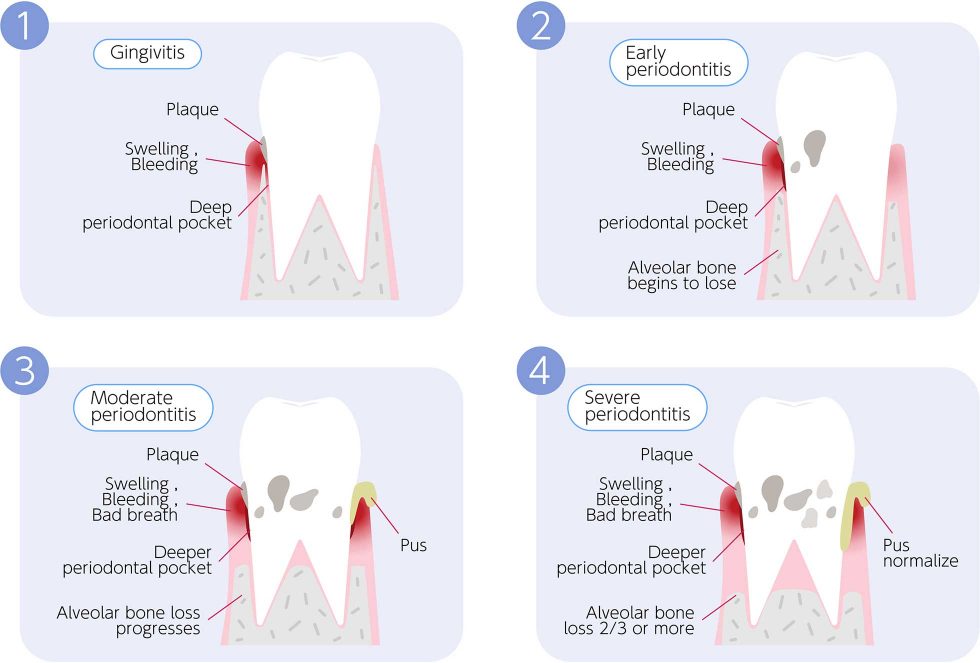 Gums’ swelling, bleeding & receding gums, Midtown New York