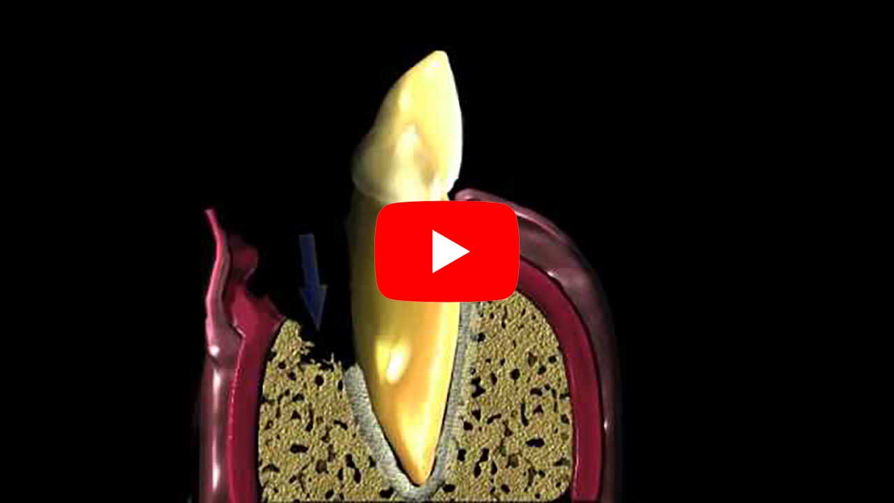 Pocket reduction surgery and osseous surgery